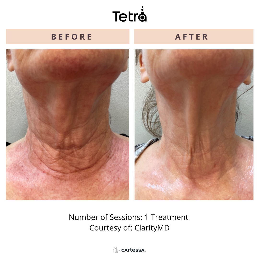 Tetra CO2 and CoolPeel Cinnaminson, NJ | Near Me | Aesthetic Renewal ...